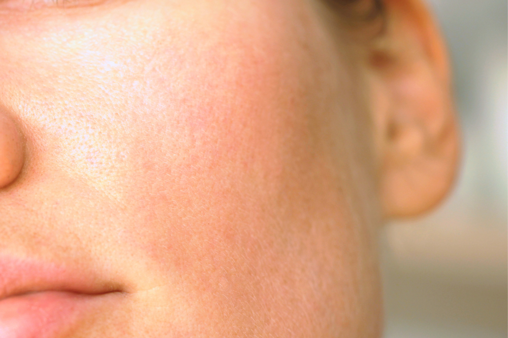 How does your gut flora affect your skin?